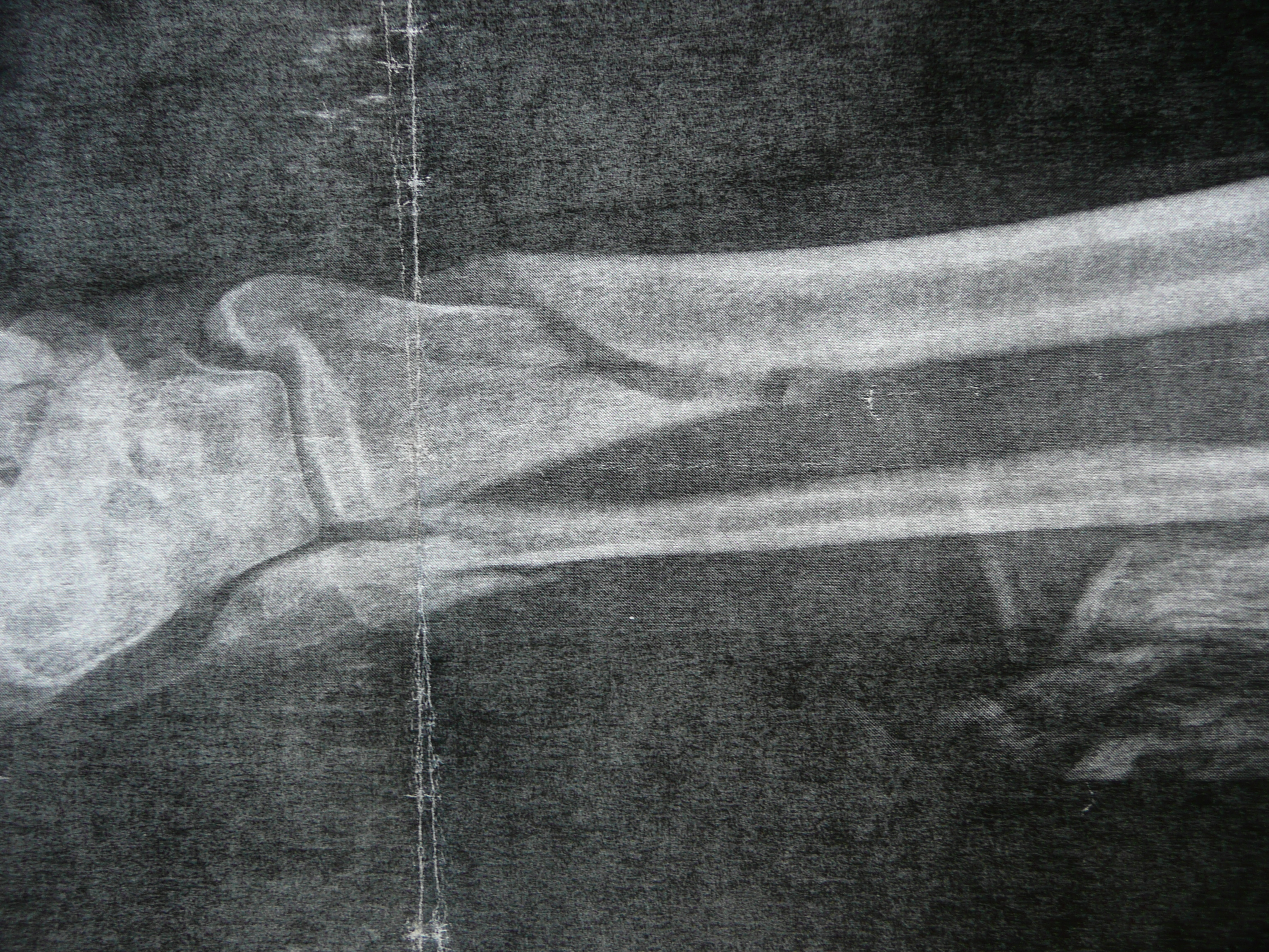 Comment éviter la fracture