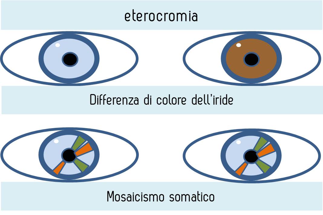 ETEROCROMIA delle iridi