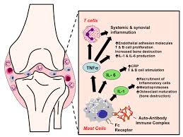 Rheumatoid Arthritus