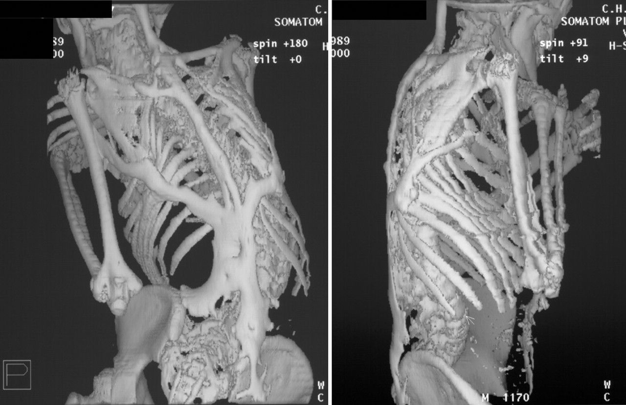 Fibrodysplasia Ossificans Progressiva (FOP)