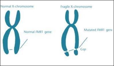 Fragile X Syndrome