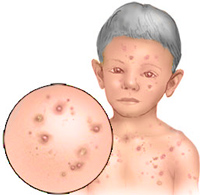 Chickenpox