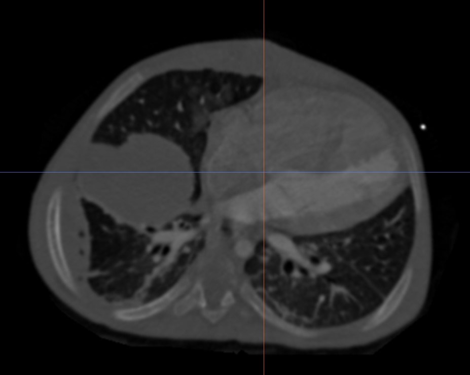 Congenital Heart Defects & Cardiovascular Anomalies