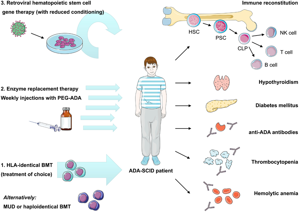 Adenosine Deaminase Deficiency