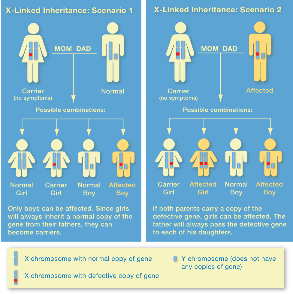 X-Linked Severe Combined Immunodeficiency