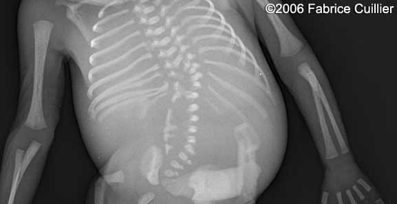Spondylocostal Dysostosis