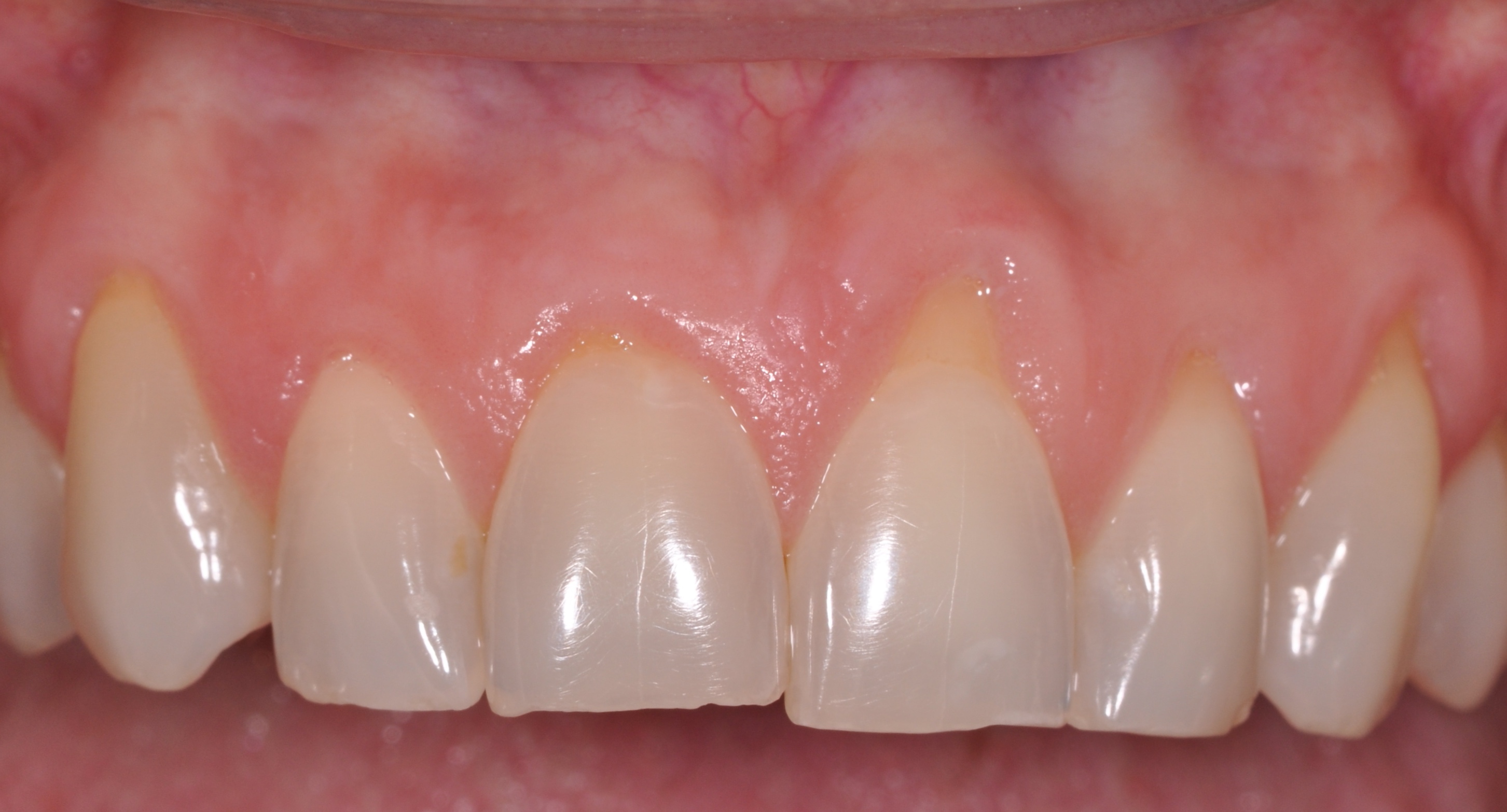 Treatment of gingival recession