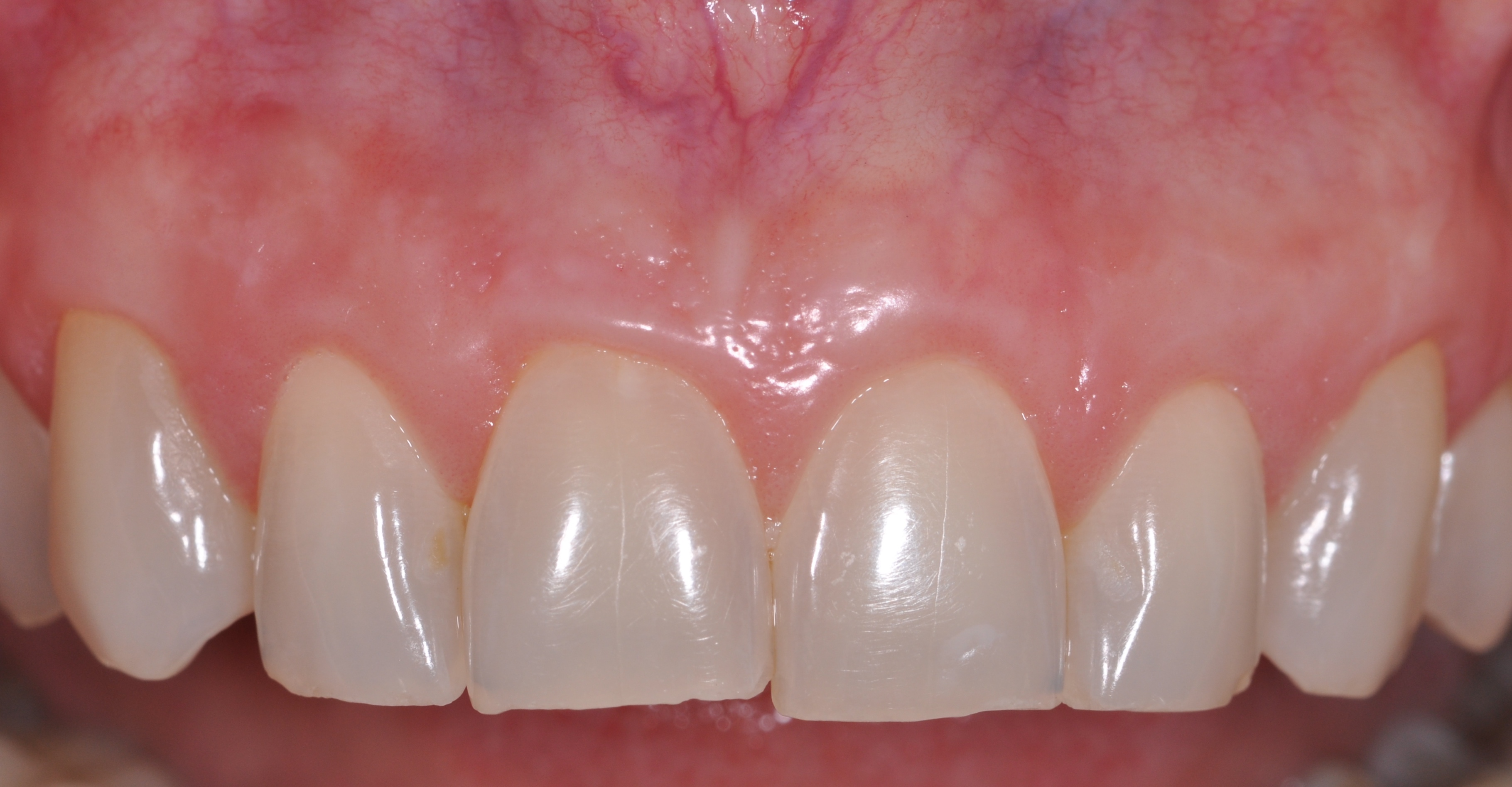Treatment of gingival recession