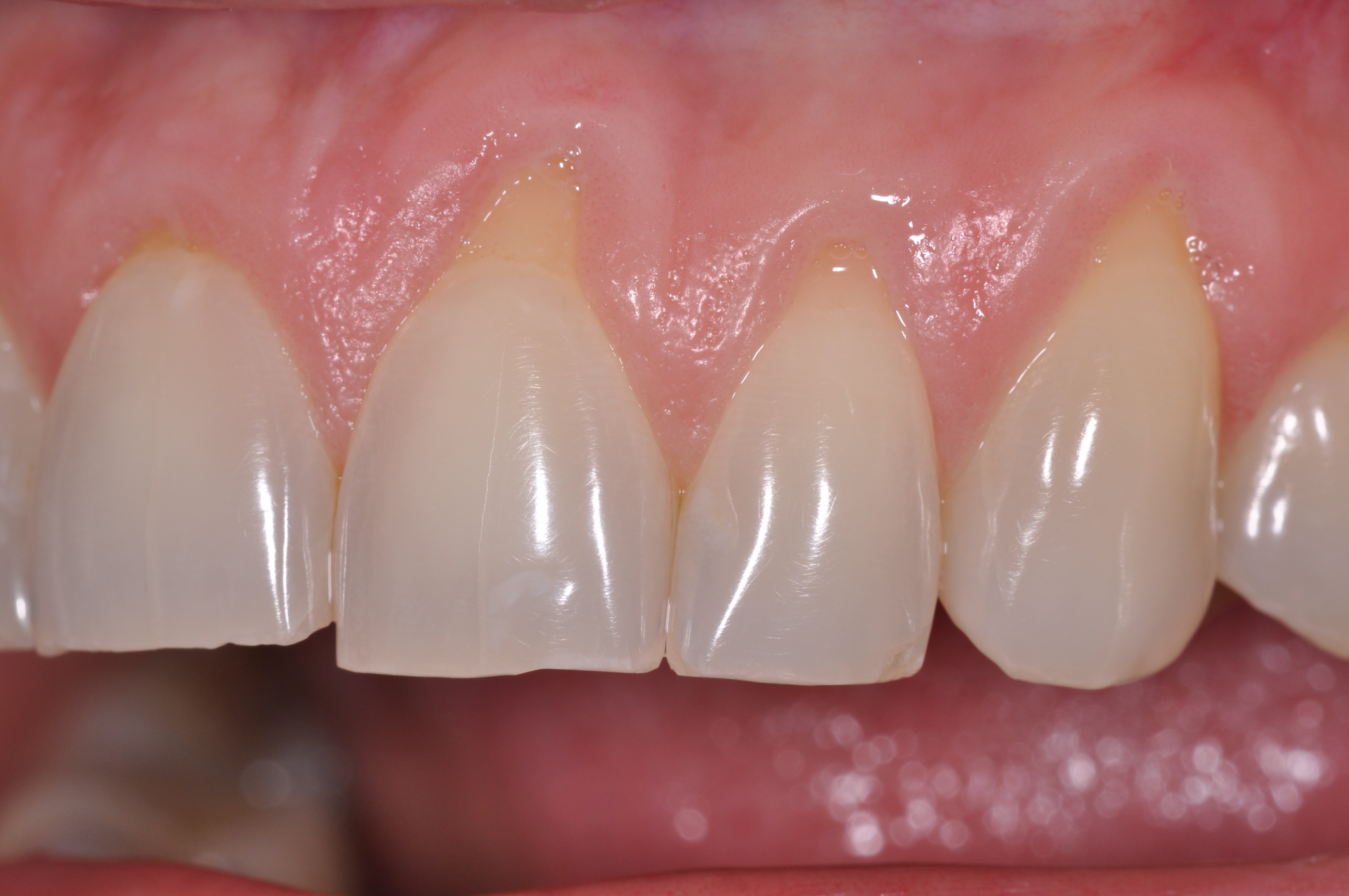 Treatment of gingival recession