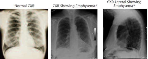 Chronic Obstructive Pulmonary Disease
