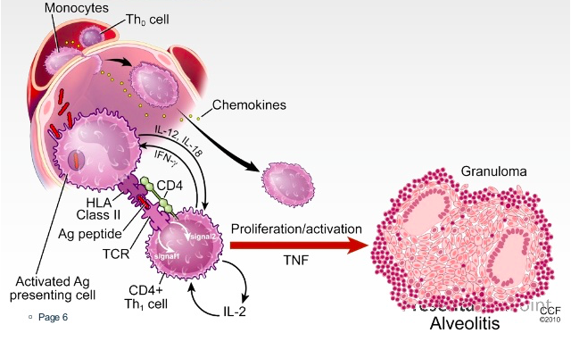 Understanding Sarcoidosis