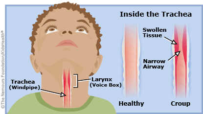 Laryngotracheobronchitis