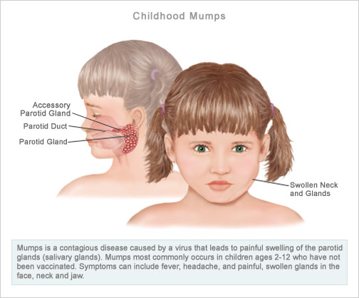parotitis symptoms