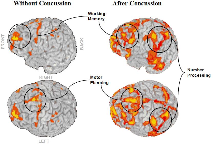 Concussions & The Brain
