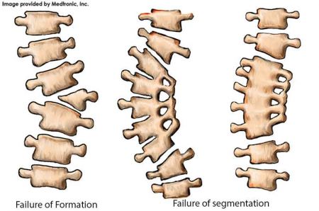 Congenital Scoliosis