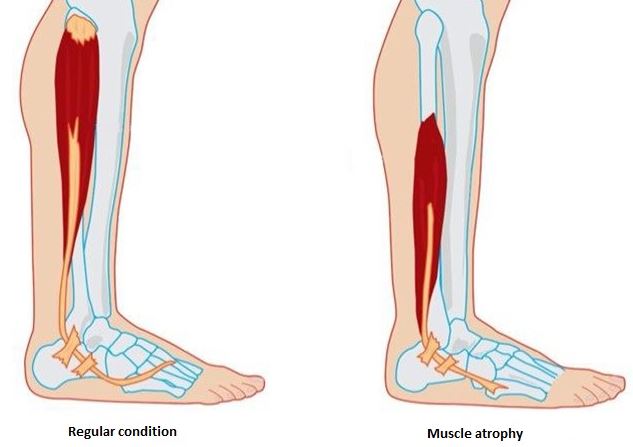 Muscle Atrophy